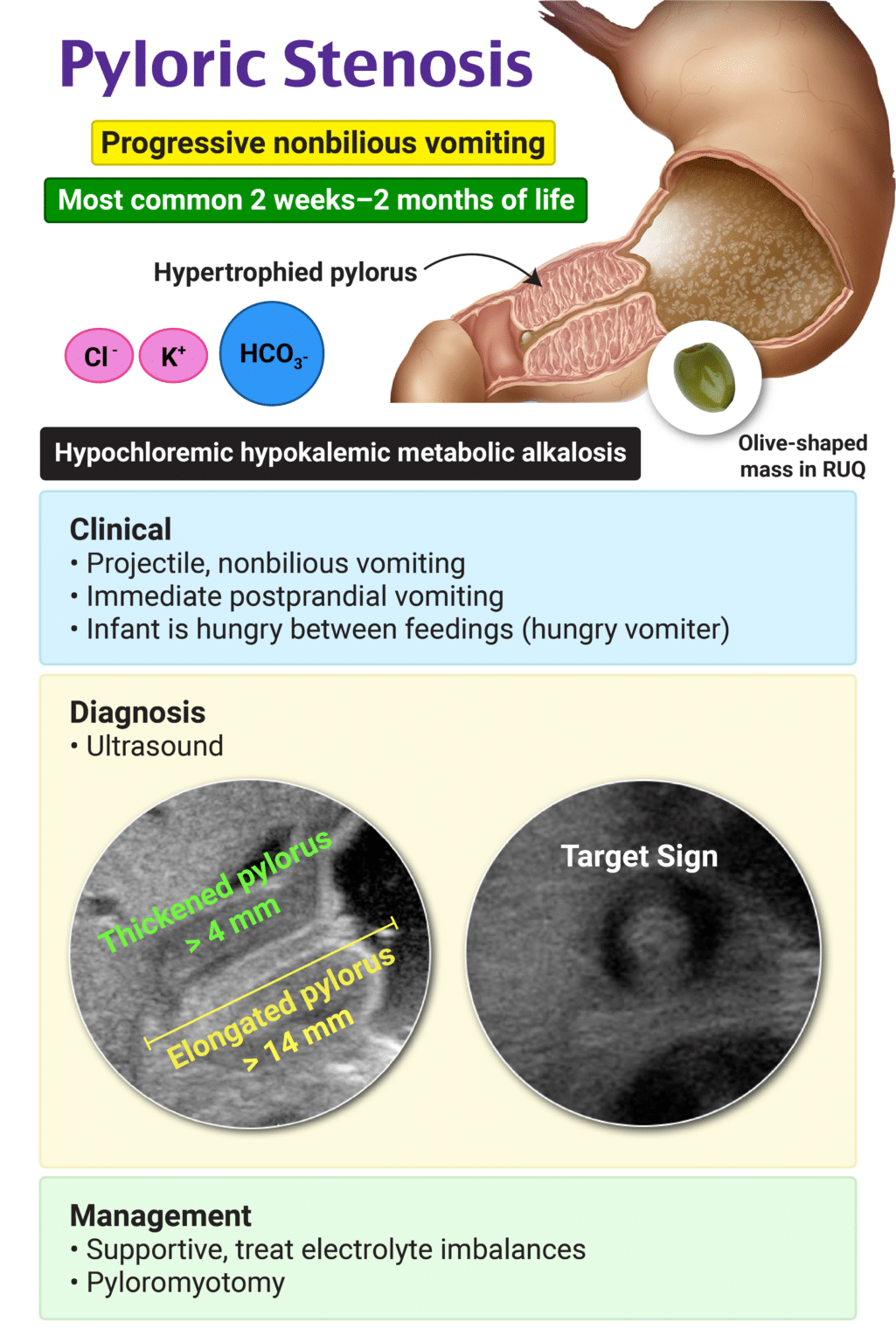 Rapid Review: Pyloric Stenosis - RoshReview.com