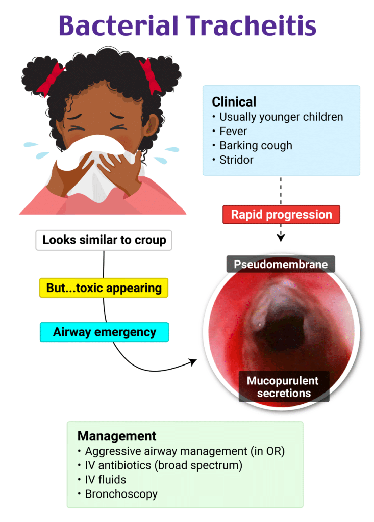 Rapid Review: Bacterial Tracheitis - RoshReview.com