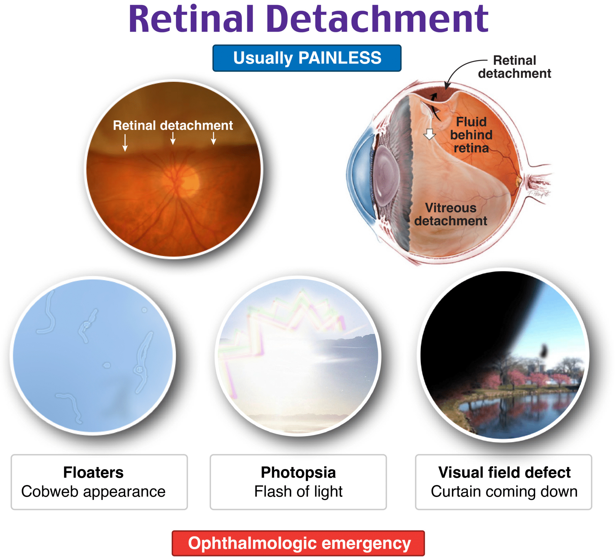 Rapid Review: Retinal Detachment - RoshReview.com