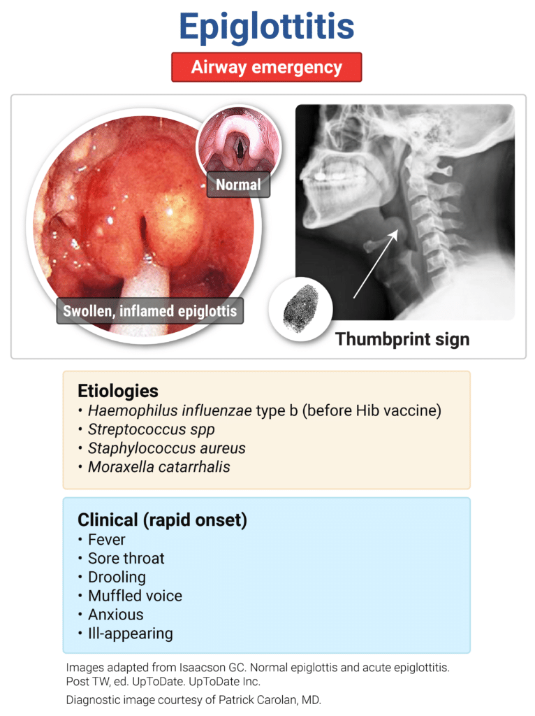 Rapid Review: Epiglottitis - RoshReview.com