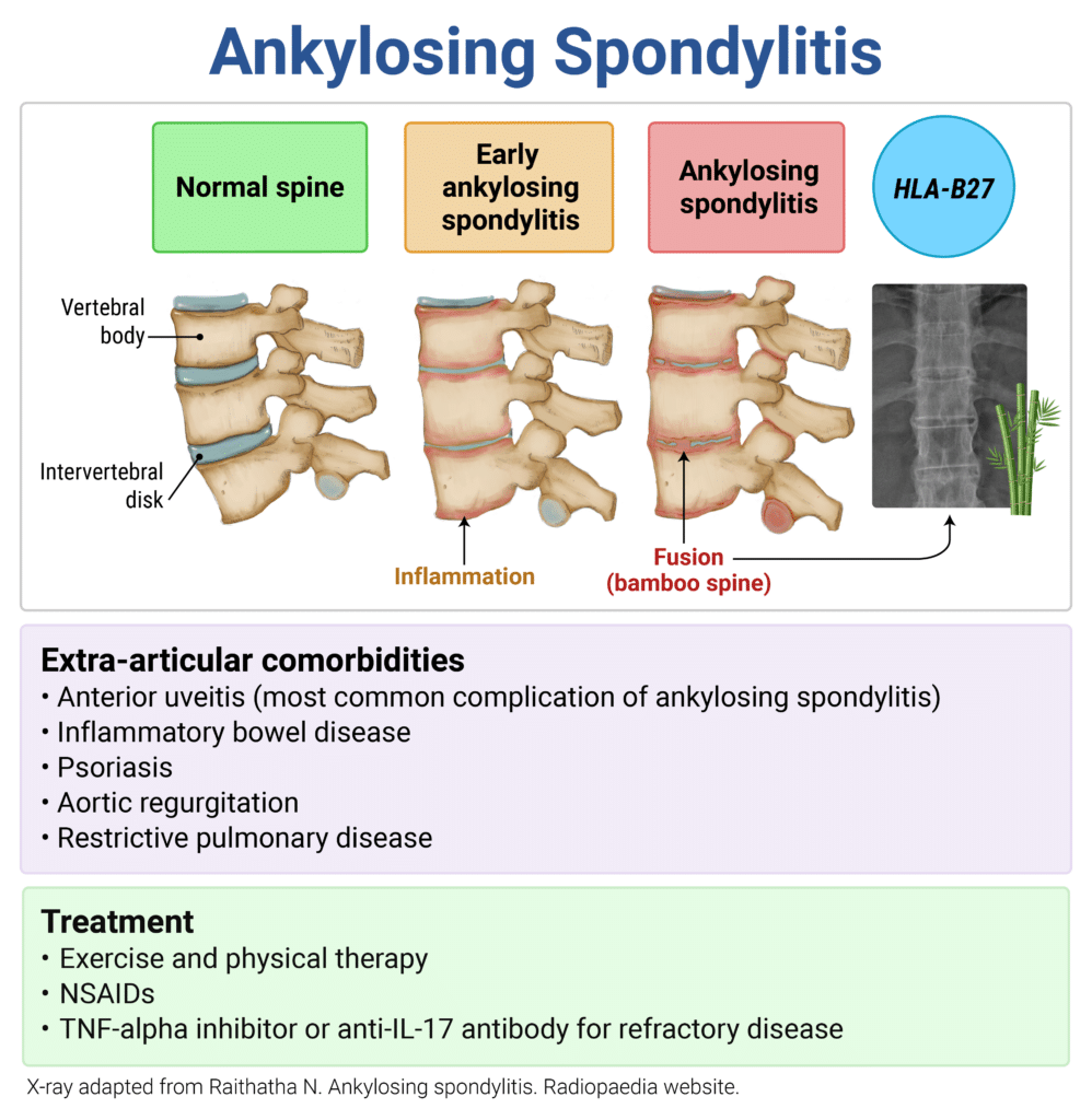 Rapid Review: Ankylosing Spondylitis - RoshReview.com