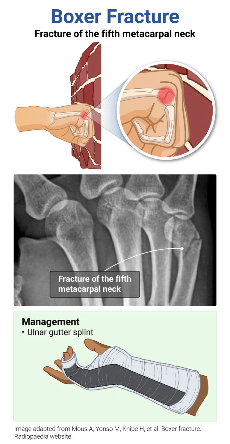 Rapid Review: Boxer Fracture - RoshReview.com