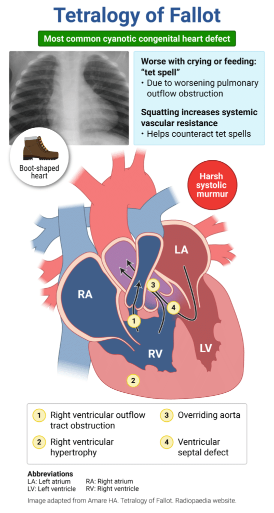 Rapid Review: Tetralogy of Fallot - RoshReview.com