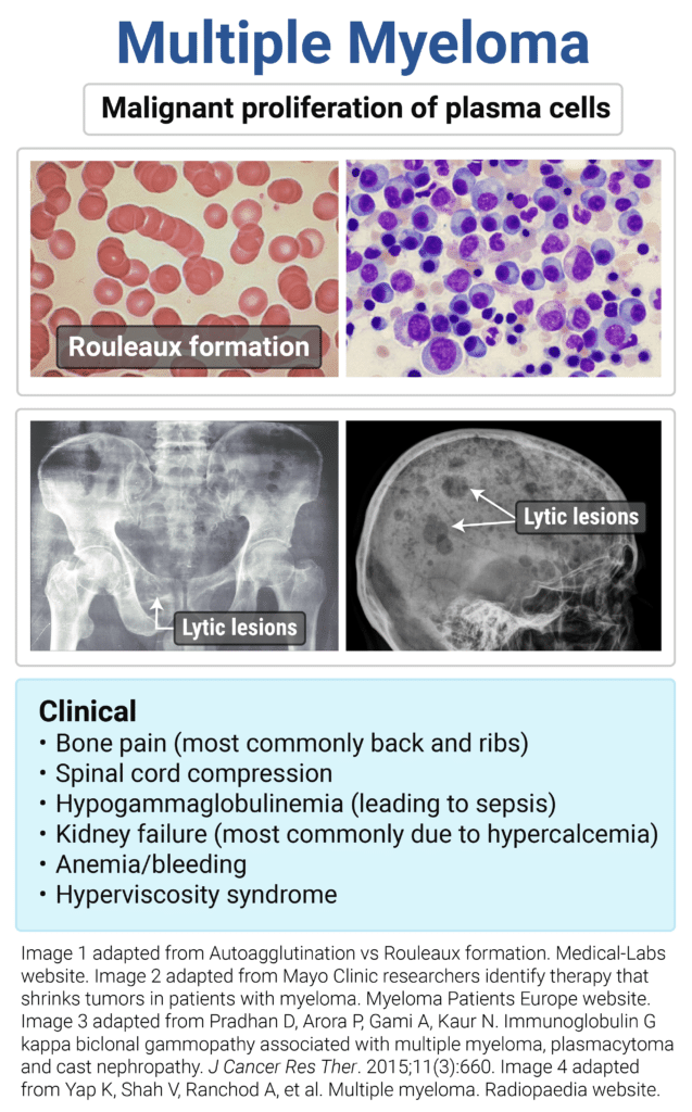 Rapid Review: Multiple Myeloma - RoshReview.com