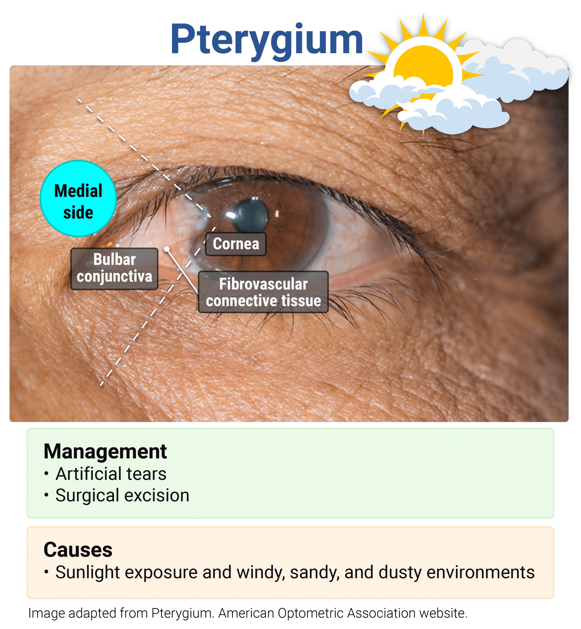 Rapid Review: Pterygium - RoshReview.com