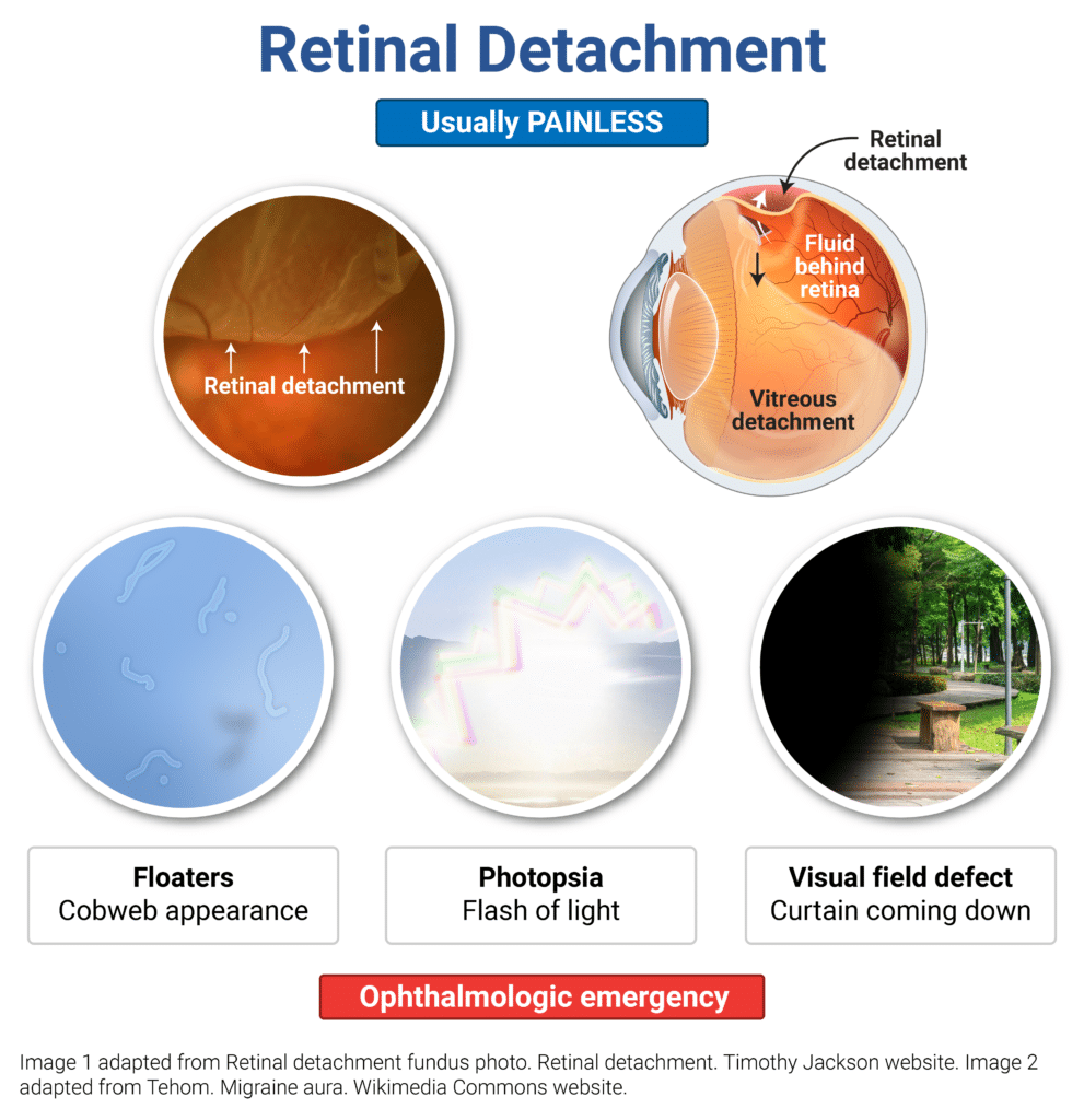 Rapid Review: Retinal Detachment - RoshReview.com
